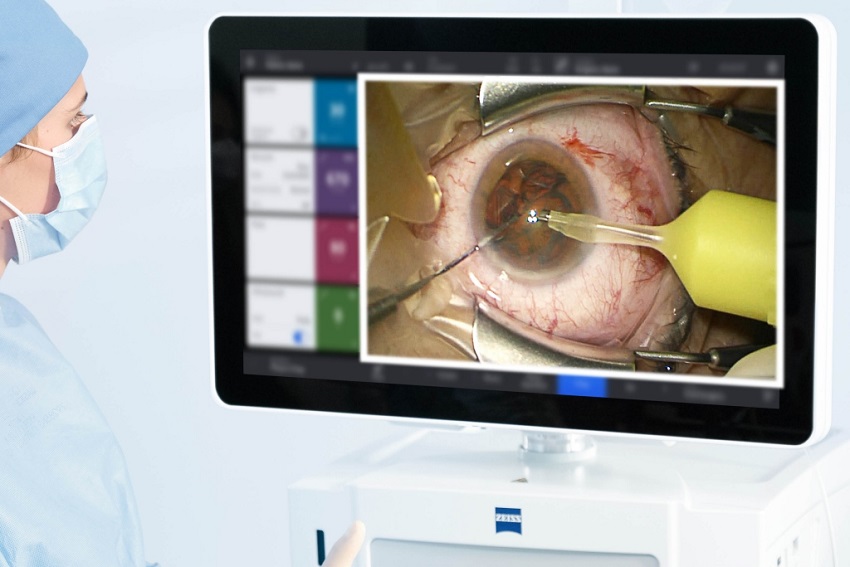 Quatera 700: cirurgia de catarata mais eficiente e segura - Medicina S/A