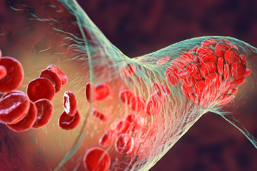 Tromboembolismo venoso acomete quase 300 mil brasileiros por ano ...